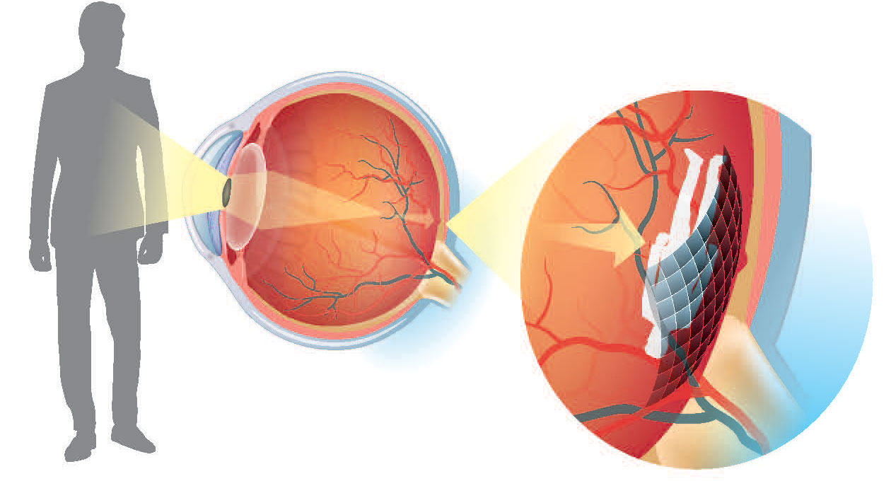 Microscopic solar cells could give vision to blind - DTU