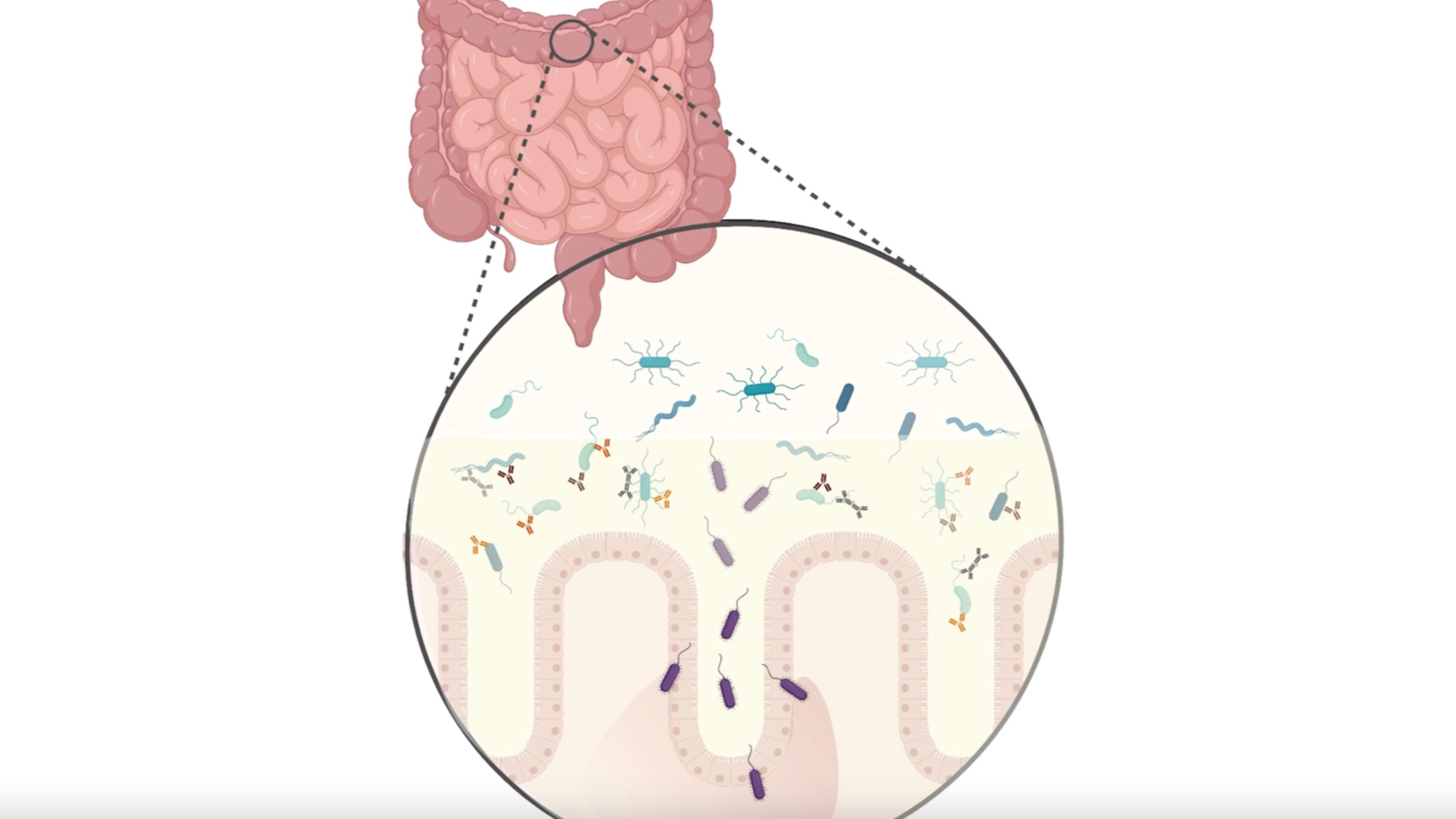Ny viden om tarmens immunforsvar kan gavne patienter med Crohns sygdom